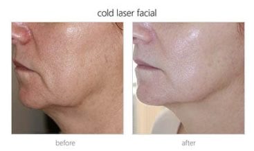 Cold Laser Facial Toronto | Versus Laser