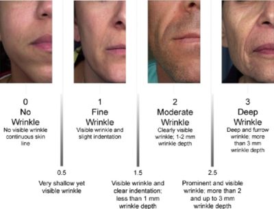 All about Wrinkles and Fine Lines - VS MedSpa Skin Clinic in Toronto